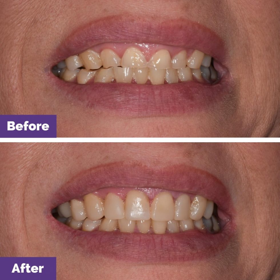 Composite Veneers Tooth Proportion Case - Gisborne Dental House