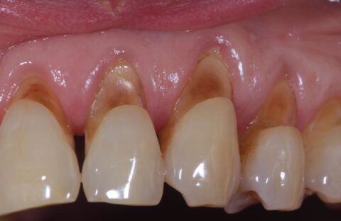 Abfraction & Abfraction Lesions: What Are They?